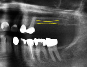 After Sinus Lift | Jackson Oral Surgery